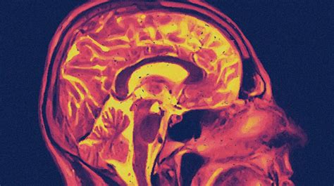 Radiation Therapy Side Effects Brain Cancer At Carla Apgar Blog