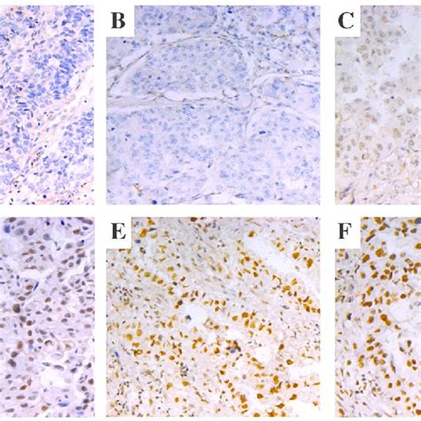 Immunohistochemical Staining Of Nipbl In Lung Adenocarcinoma The Download Scientific Diagram