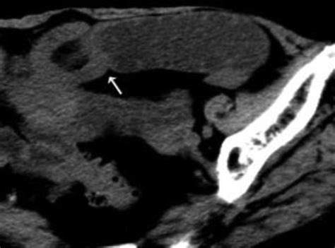 An Adult Case Of Small Bowel Intussusception Caused By Heman Medicine
