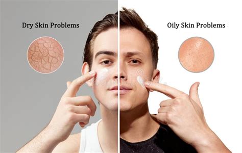 Dry Skin Vs Oily Ski Problems Young Men With Different Skin Types