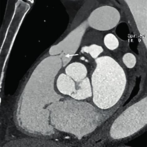 Cardiac Computed Tomography Multiplanar Reconstructions At Diastole