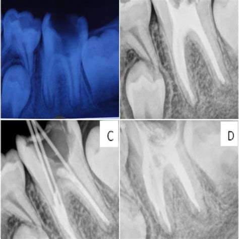 A Preoperative Radiophotographs Showed Tooth 21 Having Open Apex