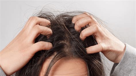 Managing Scalp Psoriasis A Holistic Approach With Natural Haircare