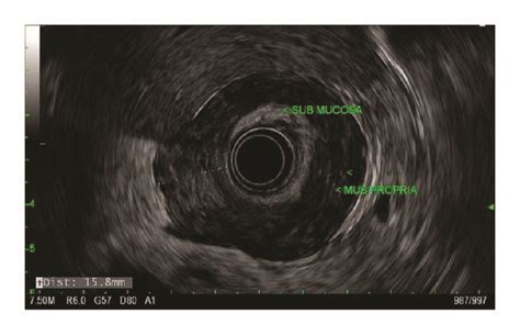 Thickened Gastric Muscularis Propria Layer On Endoscopic Ultrasound