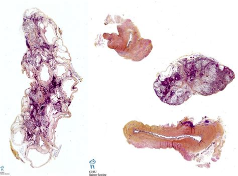 Unilateral Renal Hypoplasia Human Pathology
