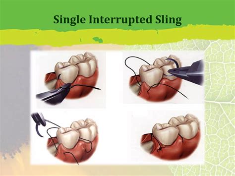 Periodontal Flap Surgery Ppt