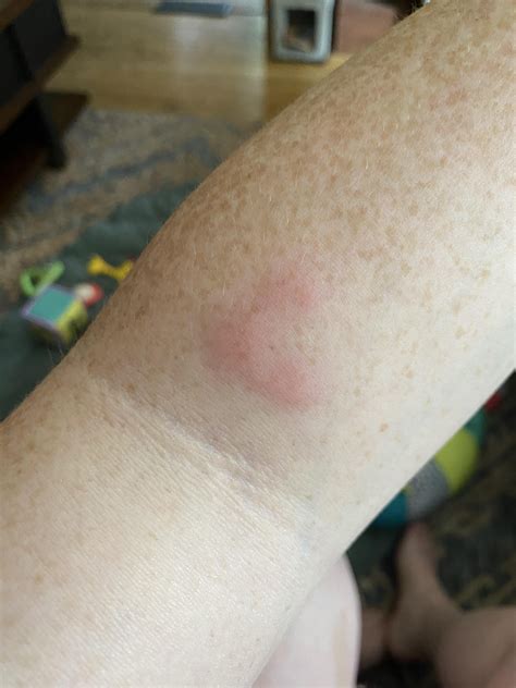 Weird Bumpy Rash This Showed Up Saturday Kind Of Out Of The Blue It