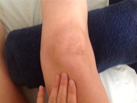 Cureus Apophysitis Of The Tibial Tuberosity Osgood Schlatter Disease A Review Article