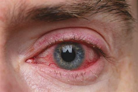 Amazing 6 Key Signs Eye Irritation Due To Ocular Rosacea