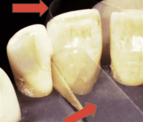 Class Iii Preparation Restoration Guide For Dental Students