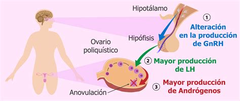 ¿qué Es El Síndrome De Ovarios Poliquísticos Sop Todo Sobre Su