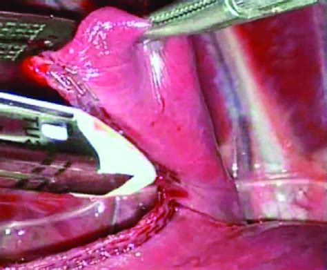 Thoracoscopic Partial Lobectomy Using Endoscopic Stapling Download