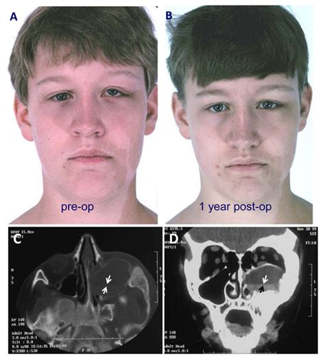 Fibrous Dysplasia With A Secondary Aneurysmal Bone Cyst Abc A The