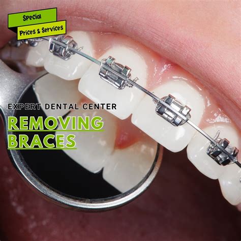Removing Braces