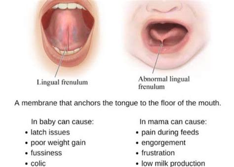 Causes Of Lingual Frenulum Medizzy
