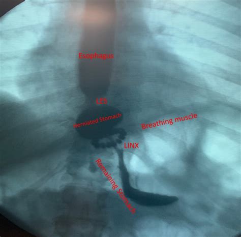 Slipped Stomach Through LINX Device Houston Heartburn And Reflux Center