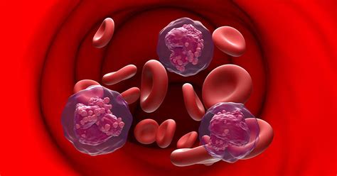 Acute Lymphoblastic Leukemia
