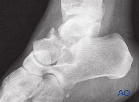Non Displaced Cervical Fracture