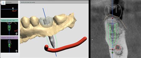 Tissue Regeneration And Arcsys Guided Surgery Fgm Dental Group