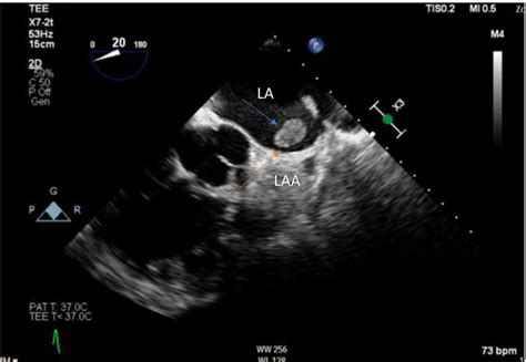 Transesophageal Echocardiogram Tee Showing Large Thrombus Blue