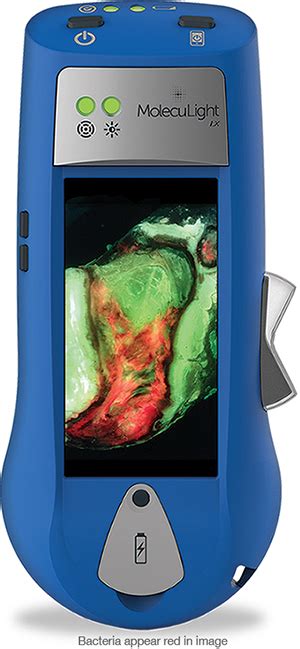 Moleculight Fda Cleared To Detect Bacteria Infected Wounds My Healthy