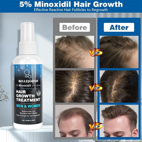 Top Minoxidil Brands To Revive Your Hairline Riosc