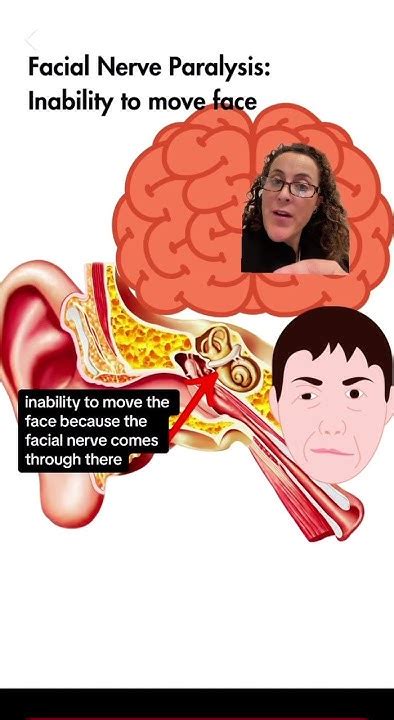 🙉😖 Mastoiditis And Other Complications From Ear Infections Mastoiditis Earinfection Abscess