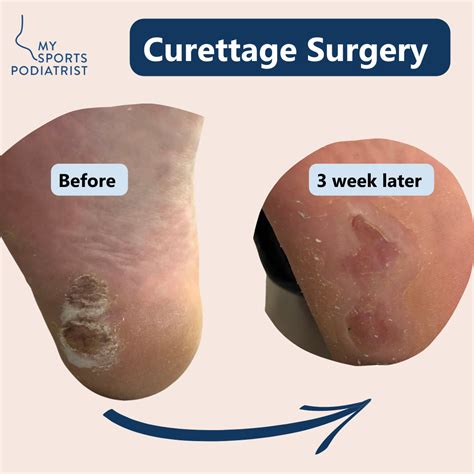 Surgical Treatment For Plantar Warts