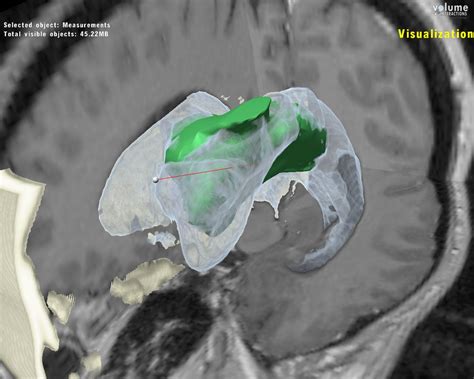 Prof Dr Med Ralf A Kockro Intraventricular Tumors Ependymoma