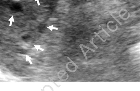 A 35 Year Old Human Immunodeficiency Virus Hiv Positive Man With