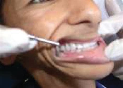 Teeth Arrangement And Try In A Teeth Size Reshaping B Teeth