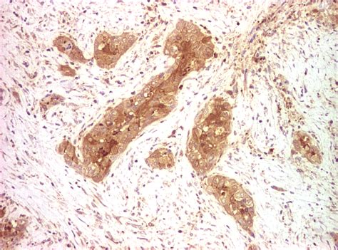 Variable Intensity Of Galectin 3 Expression In Tumor Cells Ihc
