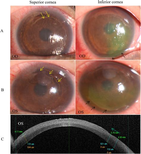 Non Traumatic Bilateral Corneal Flap Dislocation 20 Years After Lasik