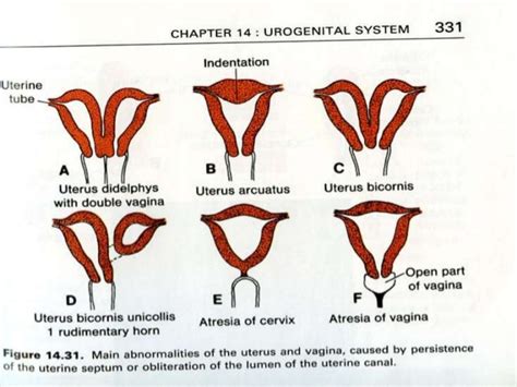 Uterus Bicornis Germany News Collections