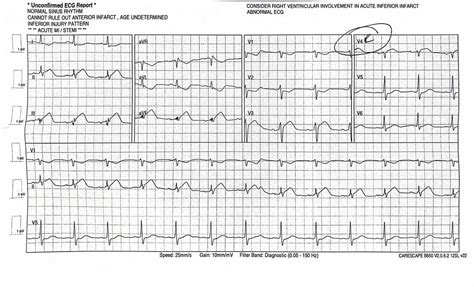 Stemi Cardiac Arrest See Comment R Ekgs