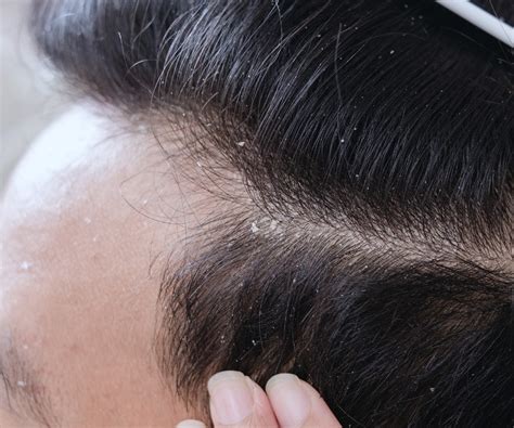 Everything Youve Always Wanted To Know About Dandruff