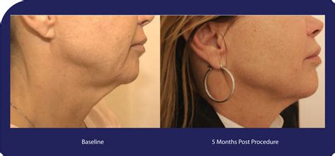 Lifting Facial Cu Ultraformer Iii Esteva Institute