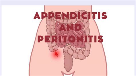 Solution Appendicitis And Peritonitis Report 2 Studypool