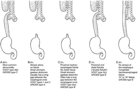 Tracheoesophageal Fistula Classification