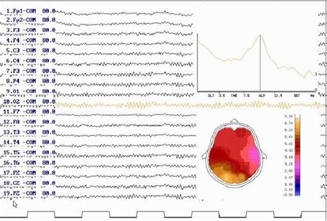 1 Señal de EEG normal Tomado de Marañón y otros 2011 Download