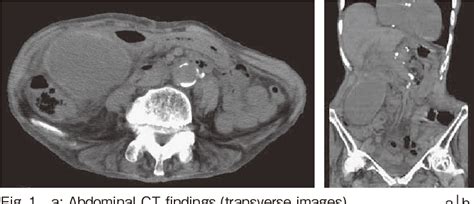 Figure 1 From A Case Of Gallbladder Volvulus Diagnosed Preoperatively And Treated With