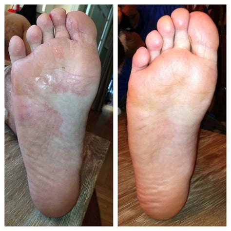What Does Athletes Foot On Heel Look Like At Beau Galway Blog