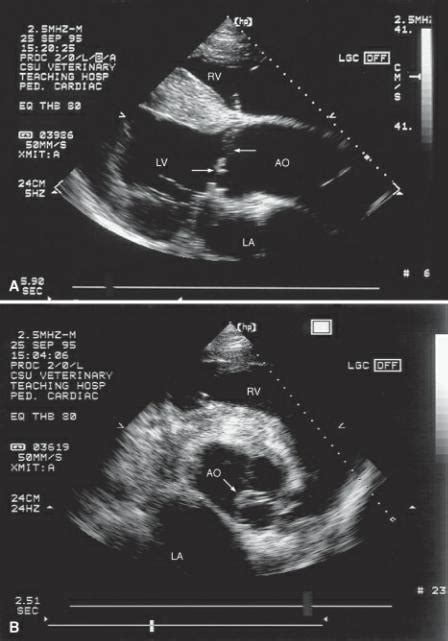 Aortic Regurgitation