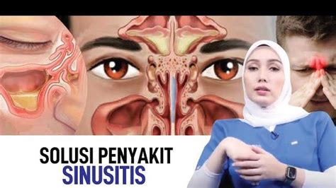 5 Cara Mudah Dan Ampuh Mengatasi Penyakit Sinus Dengan Cepat Tanpa