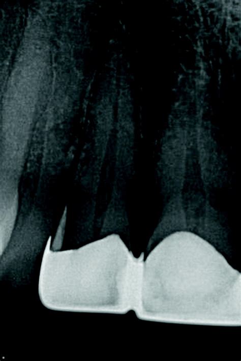 6 Local Contributing Factors Pocket Dentistry