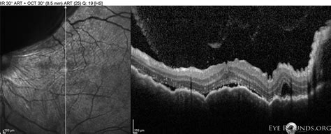 Atlas Entry Mantle Cell Lymphoma With Choroidal Metastasis