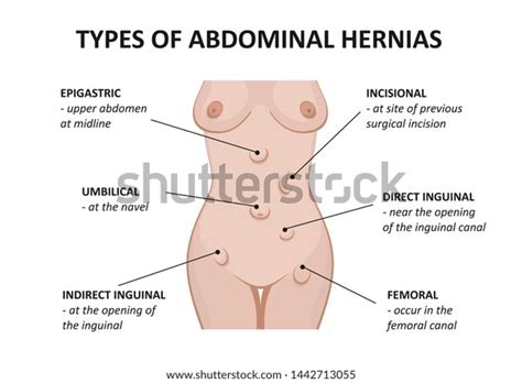 Types Abdominal Hernias Illustration Stock Illustration Shutterstock