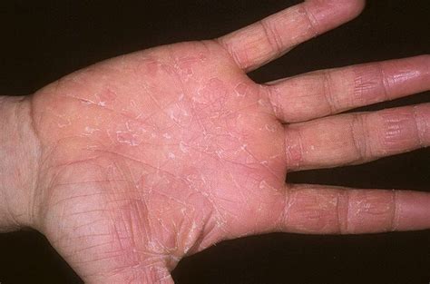 Сухая экзема на руках фото 475 шт