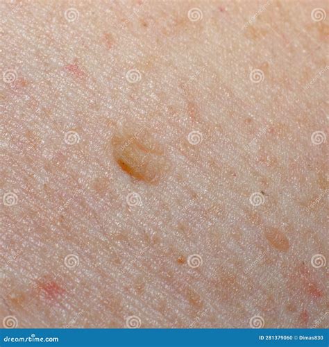 Nevus Or Mole On The Human Body Closeup Skin Cancer Keratosis Or