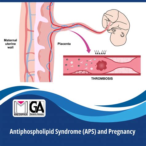 New Diagnostic Insights In Antiphospholipid Syndrome Aps And Pregnancy